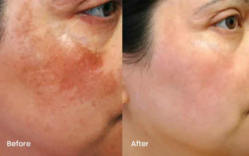 Yellow Peel Pigmentation & Brightening | Kaya Skin Clinic UAE